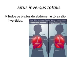 Situs inversus | PPTX