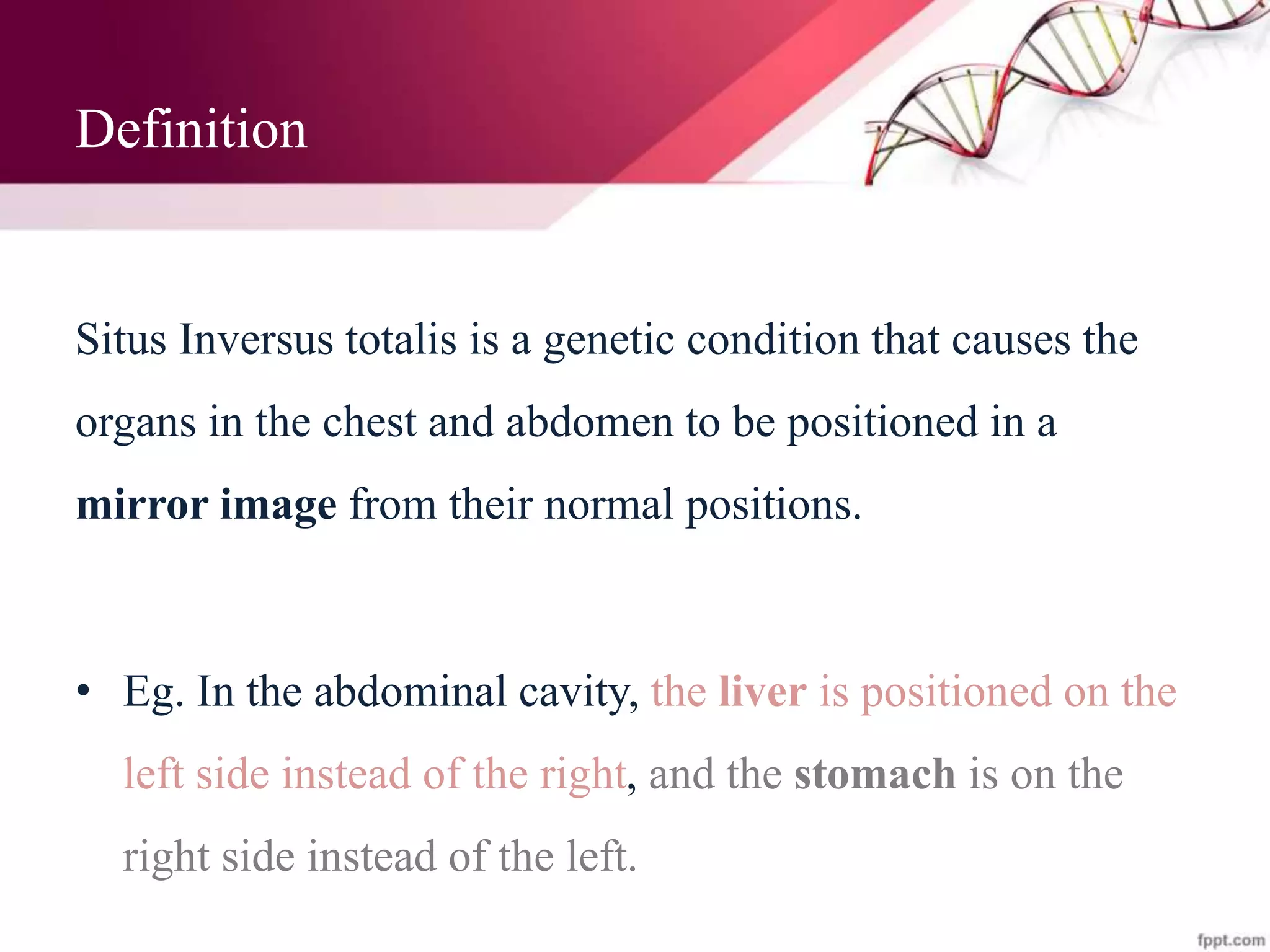 Situs inversus totalis | PPTX