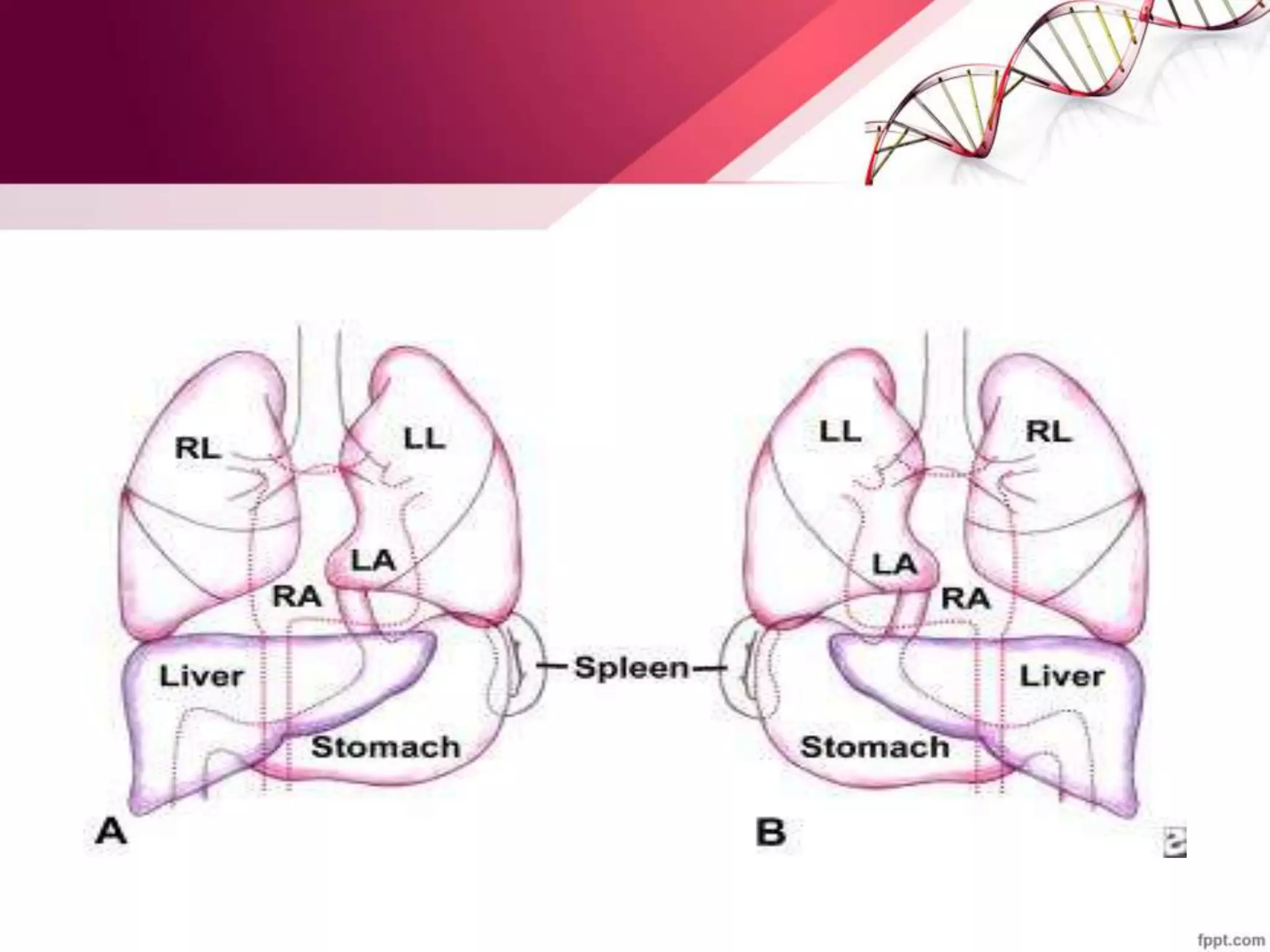 Situs inversus totalis | PPTX