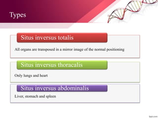 Situs inversus totalis | PPTX