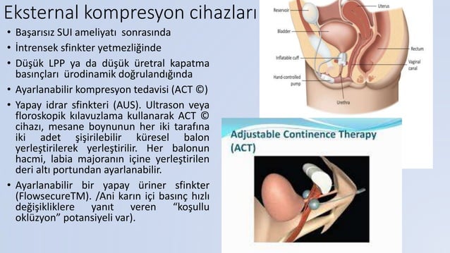 Stress Urinary Incontinence In Women 2018 Update Of Eau Guideline