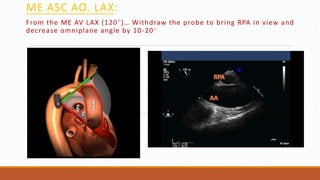 Transesophageal echocardiography | PPTX