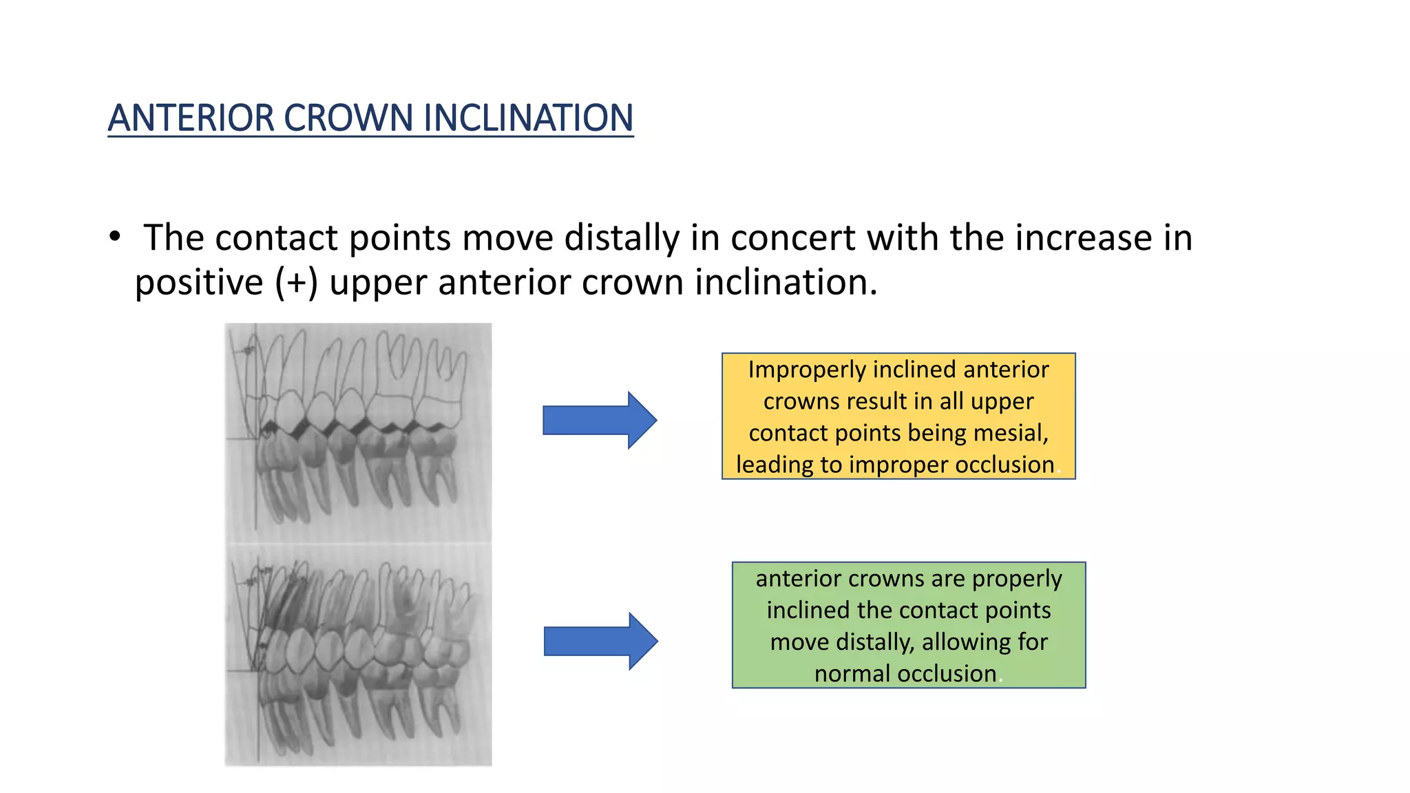 Andrews Six key of occlusion | PPTX