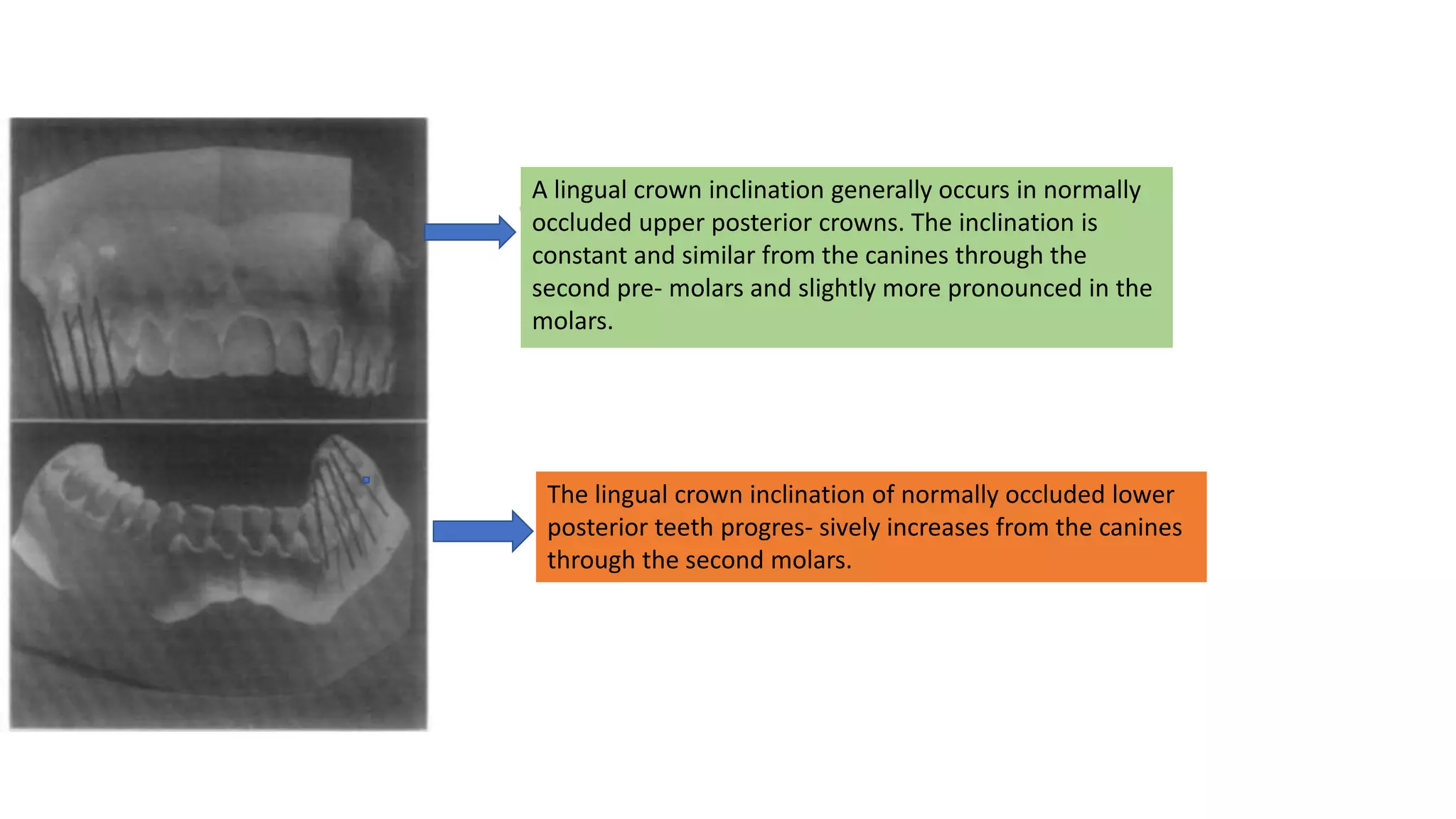 Andrews Six key of occlusion | PPTX