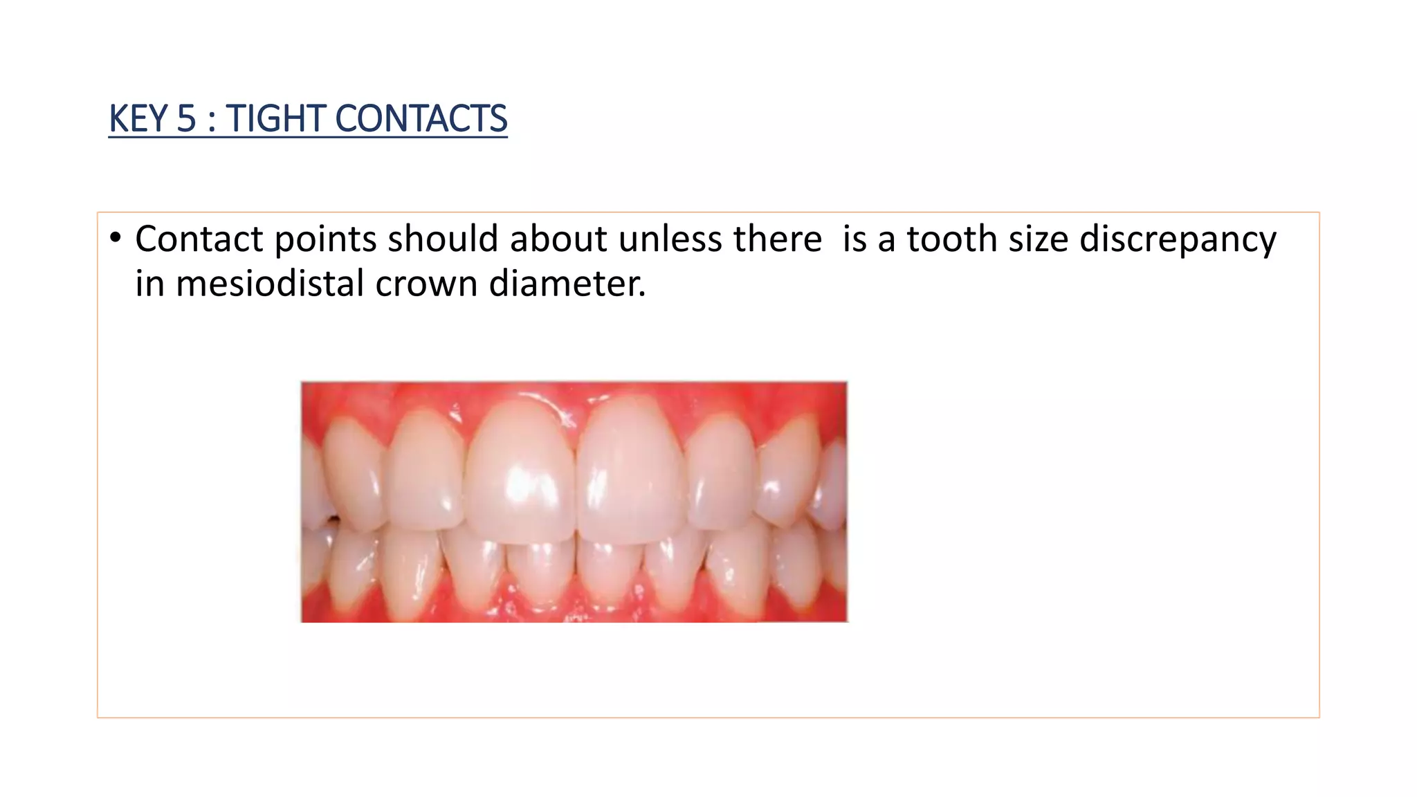 Andrews Six key of occlusion | PPTX