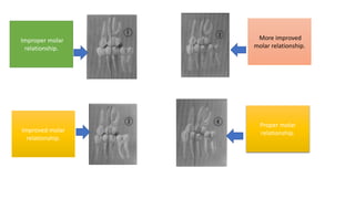 Andrews Six key of occlusion | PPTX
