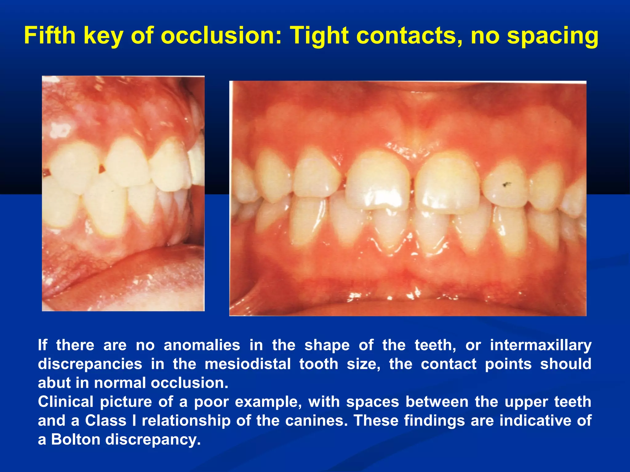 Six keys of normal occlusion - Dr. Maher Fouda | PPT | Dental Health ...
