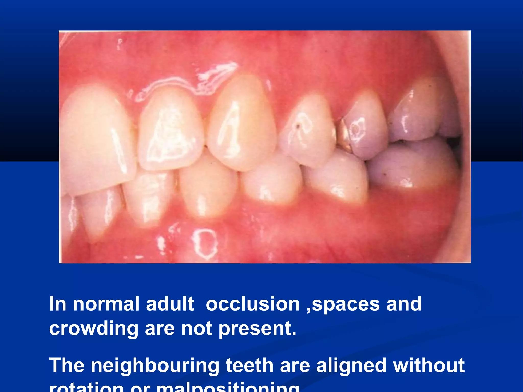 Six keys of normal occlusion - Dr. Maher Fouda | PPT | Dental Health ...