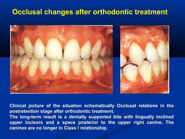 Six keys of normal occlusion - Dr. Maher Fouda | PPT | Dental Health ...
