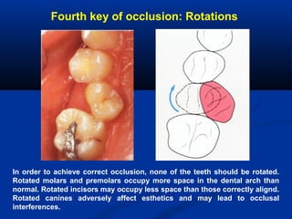 Six keys of normal occlusion - Dr. Maher Fouda | PPT