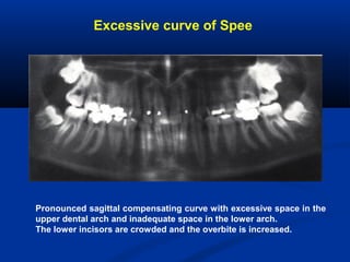 Six keys of normal occlusion - Dr. Maher Fouda | PPT