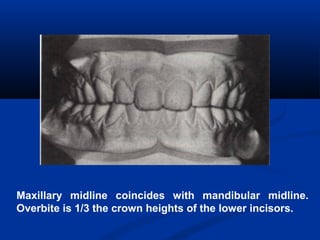 Six keys of normal occlusion - Dr. Maher Fouda | PPT