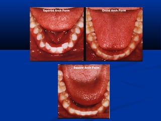 Six keys of normal occlusion - Dr. Maher Fouda | PPT