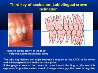 Six keys of normal occlusion - Dr. Maher Fouda | PPT