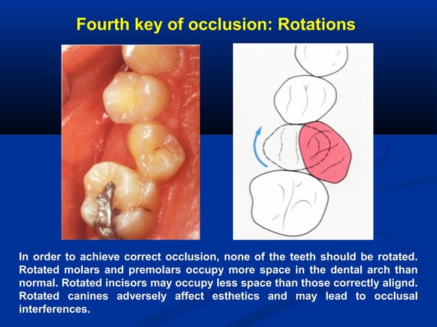 Six keys of normal occlusion - Dr. Maher Fouda