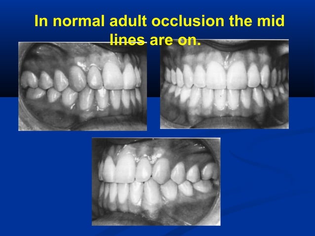 Six keys of normal occlusion - Dr. Maher Fouda