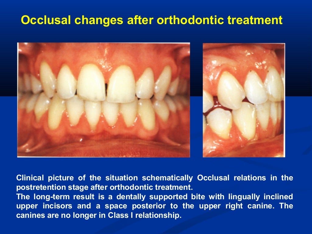 Six keys of normal occlusion - Dr. Maher Fouda