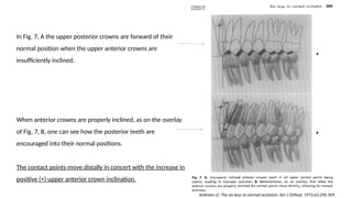 ANDREWS SIX KEYS TO OCCLUSION by Dr. L.F. Andrews | PPT