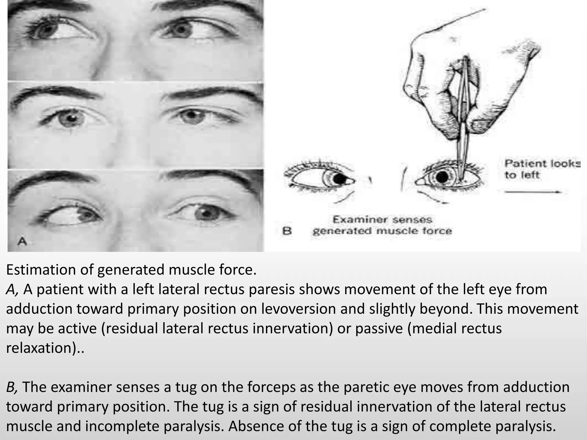 Sixth and seventh cranial nerves: anatomy and disorders | PPTX