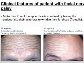Sixth and seventh cranial nerves: anatomy and disorders | PPTX