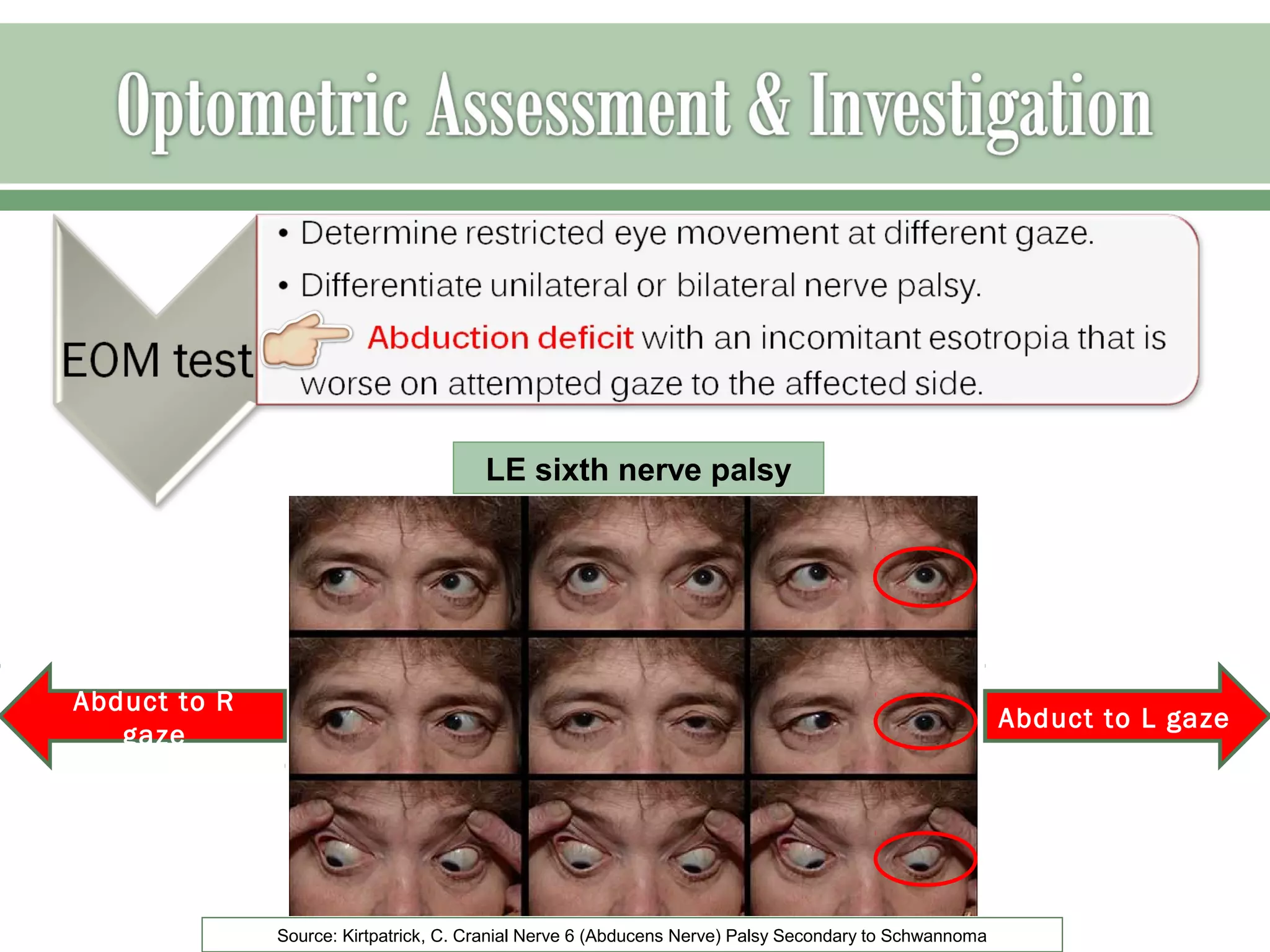 Sixth nerve palsy | PPT