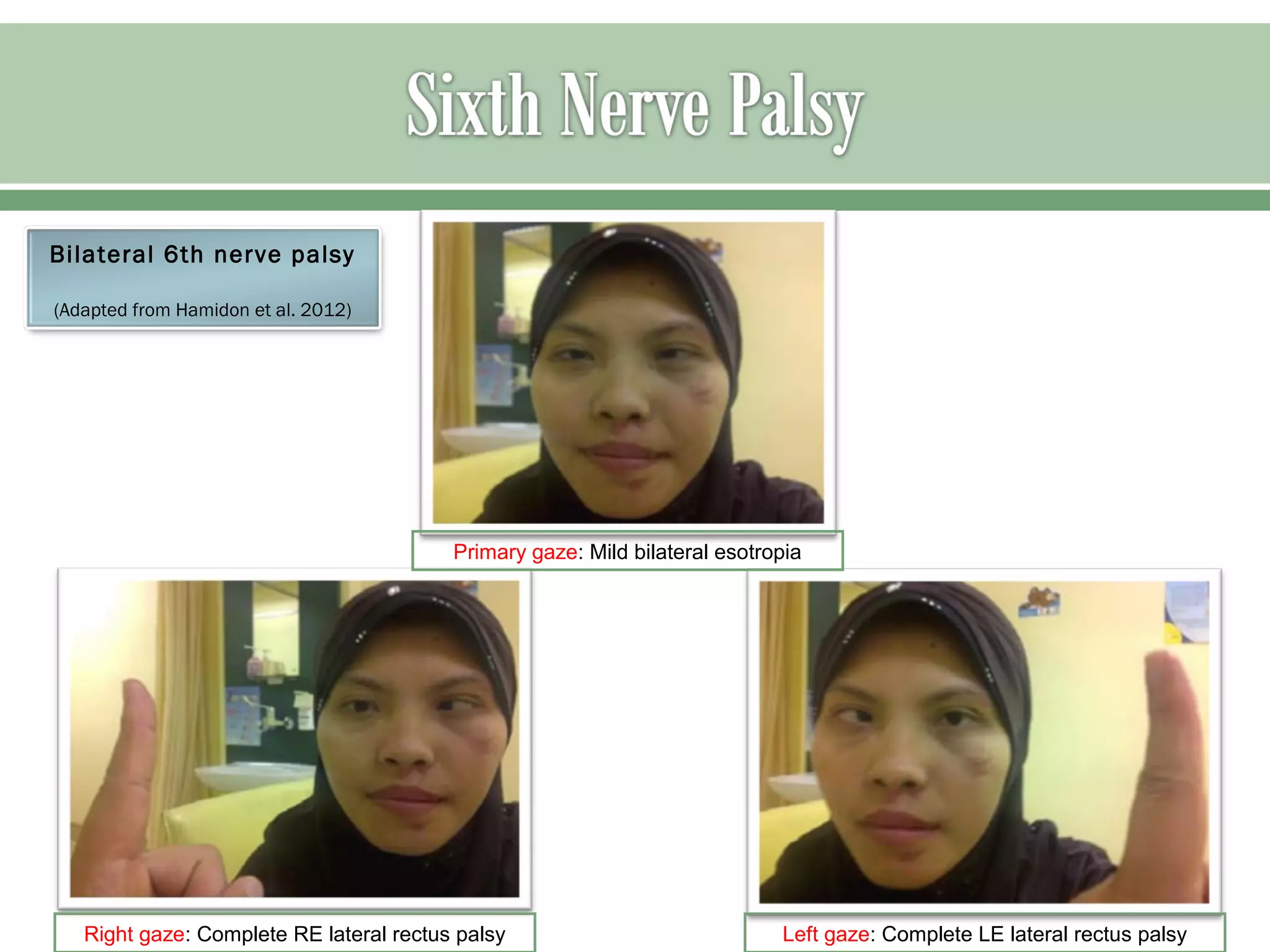 Sixth nerve palsy | PPT