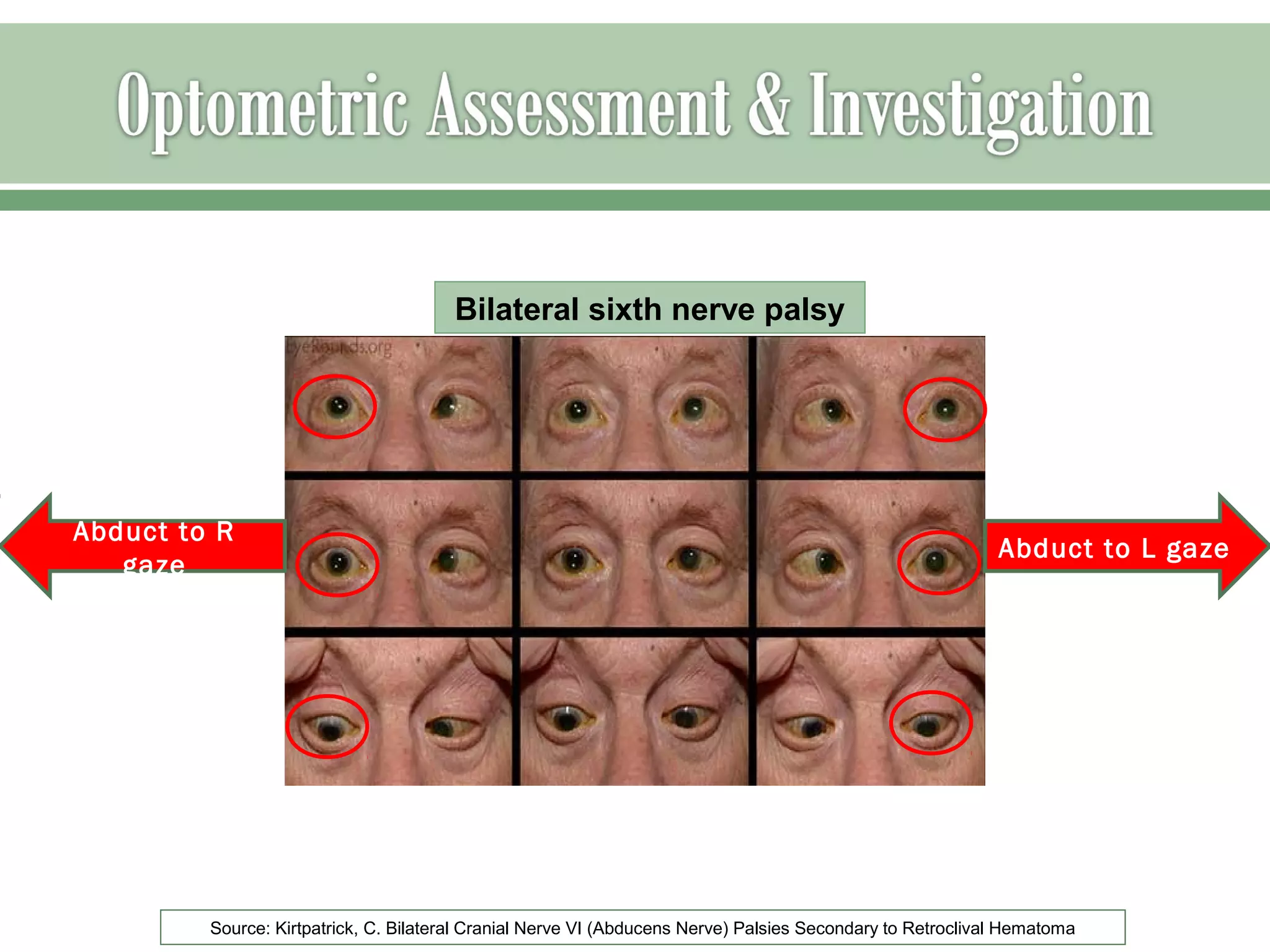 Sixth nerve palsy