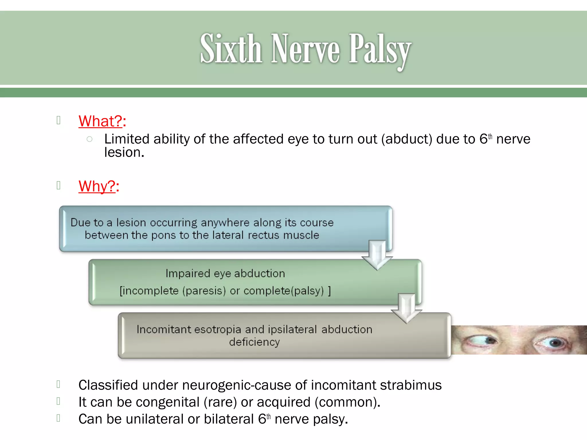 Sixth nerve palsy