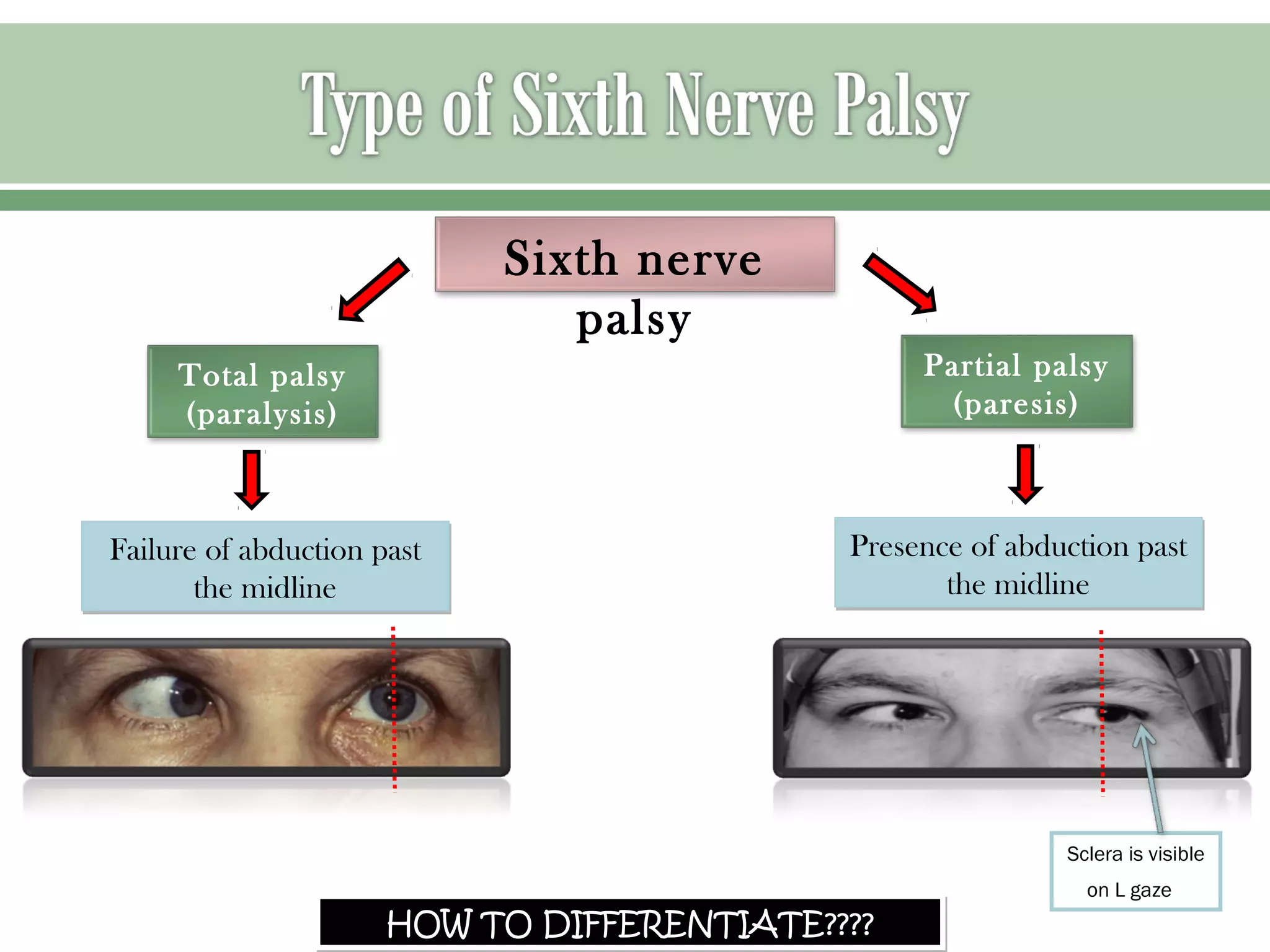 Sixth nerve palsy