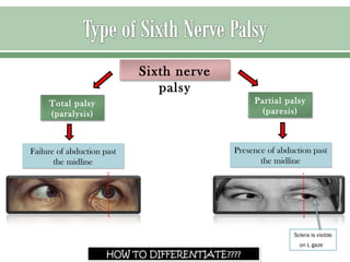 Cranial Nerve 6 Palsy