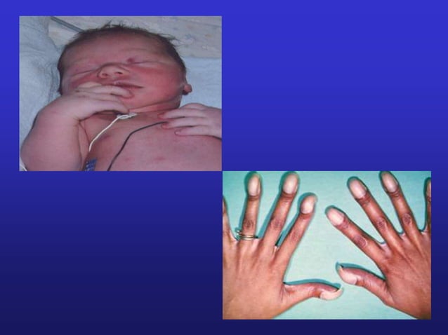 Siyanotik kongenital kalp hastaliklari genel tanimlar dr. yusuf kenan ...