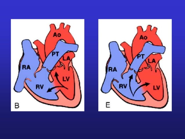 Siyanotik kongenital kalp hastaliklari genel tanimlar dr. yusuf kenan ...