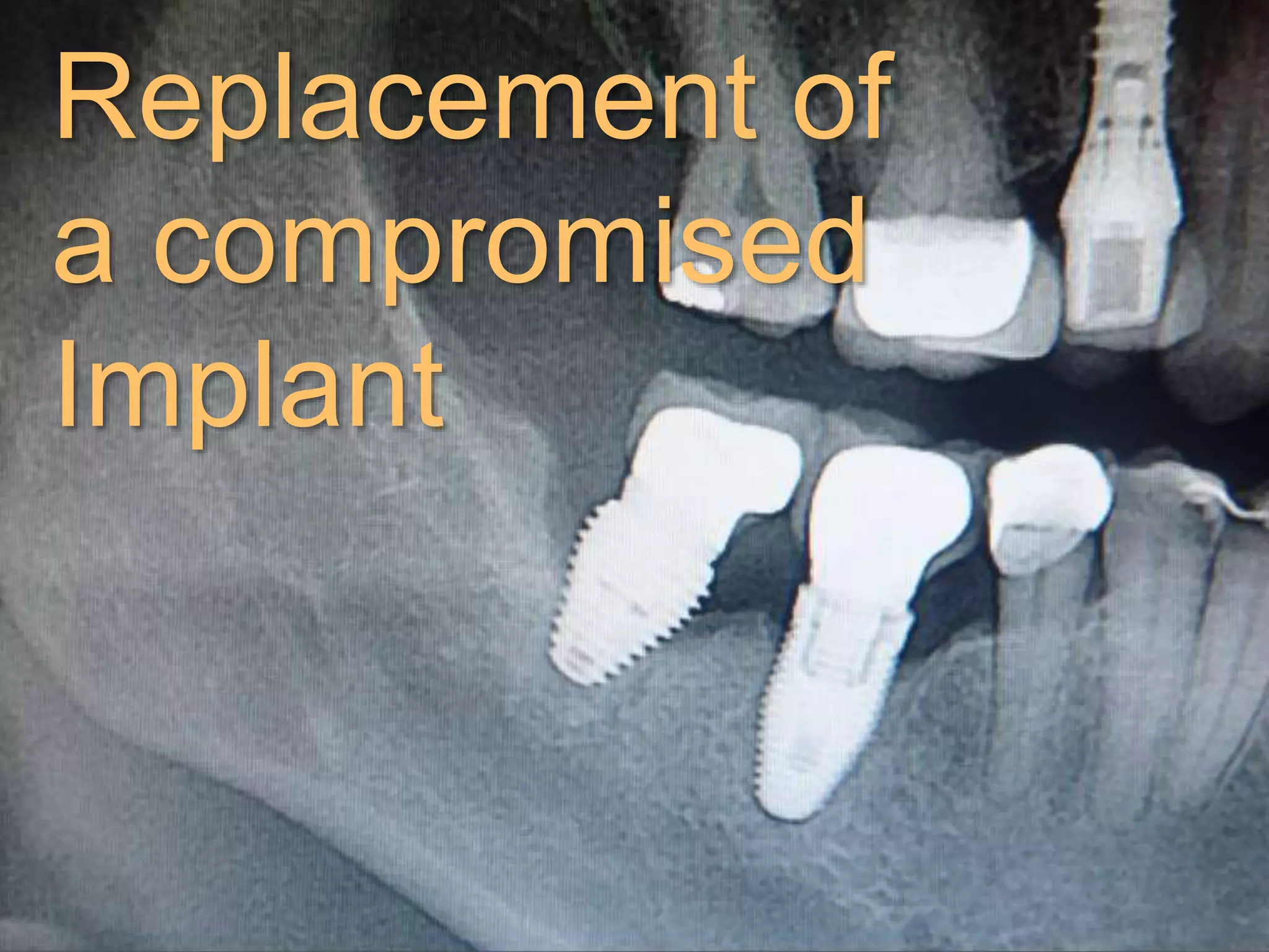 Replacement of a compromised Implant | PPT