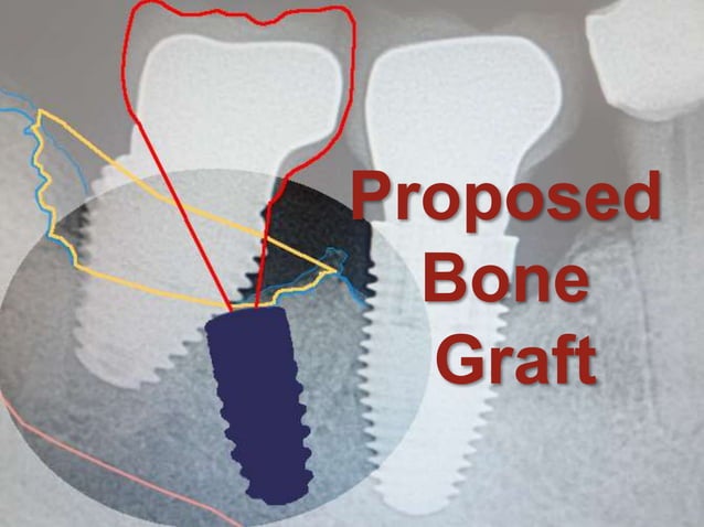 Replacement of a compromised Implant | PPT