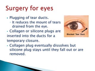 Sjögren's syndrome | PPTX