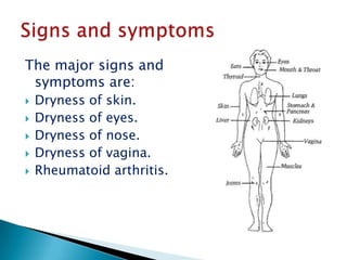Sjögren's syndrome | PPTX