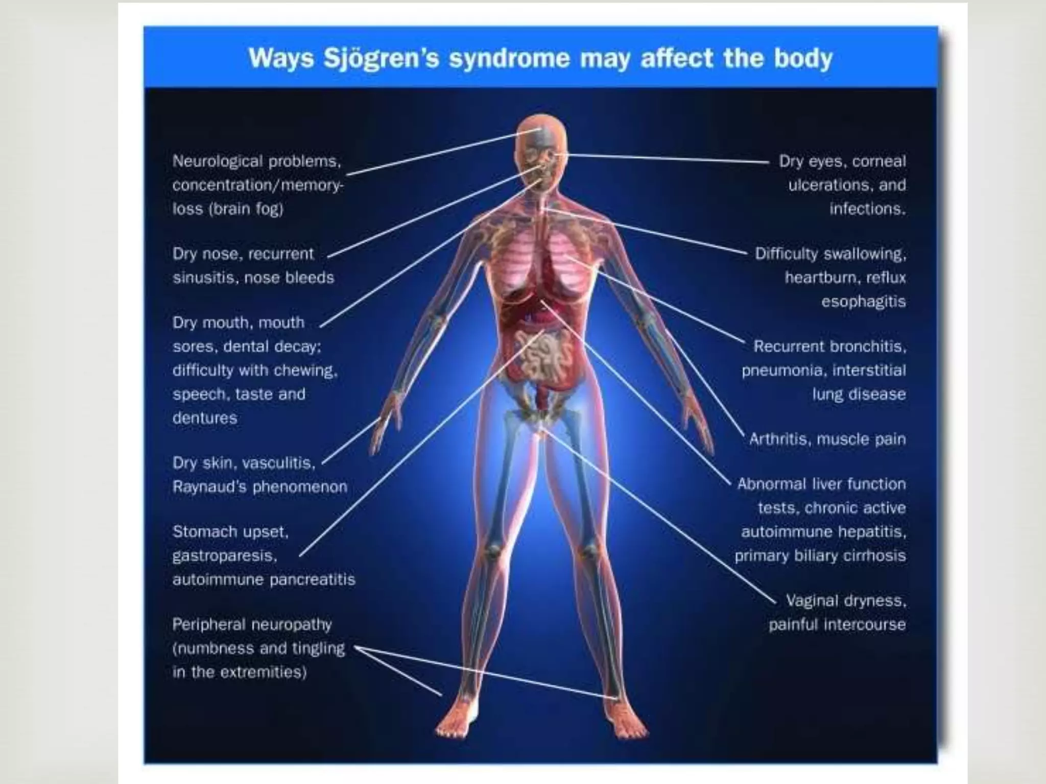 Sjogren Syndrome- a complex CNS disease | PPTX