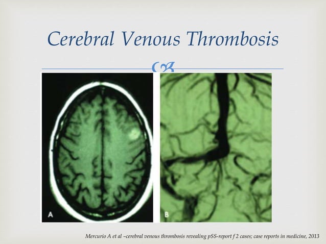 Sjogren Syndrome- a complex CNS disease | PPT