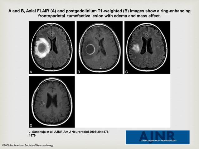 Sjogren Syndrome- a complex CNS disease | PPT