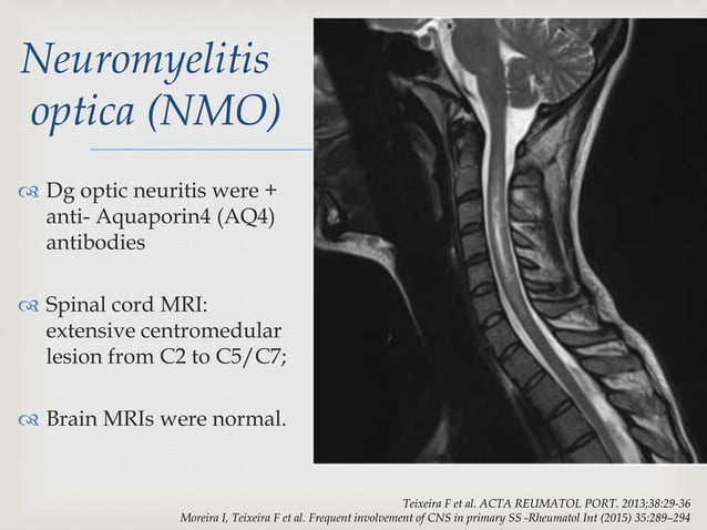 Sjogren Syndrome- a complex CNS disease | PPT