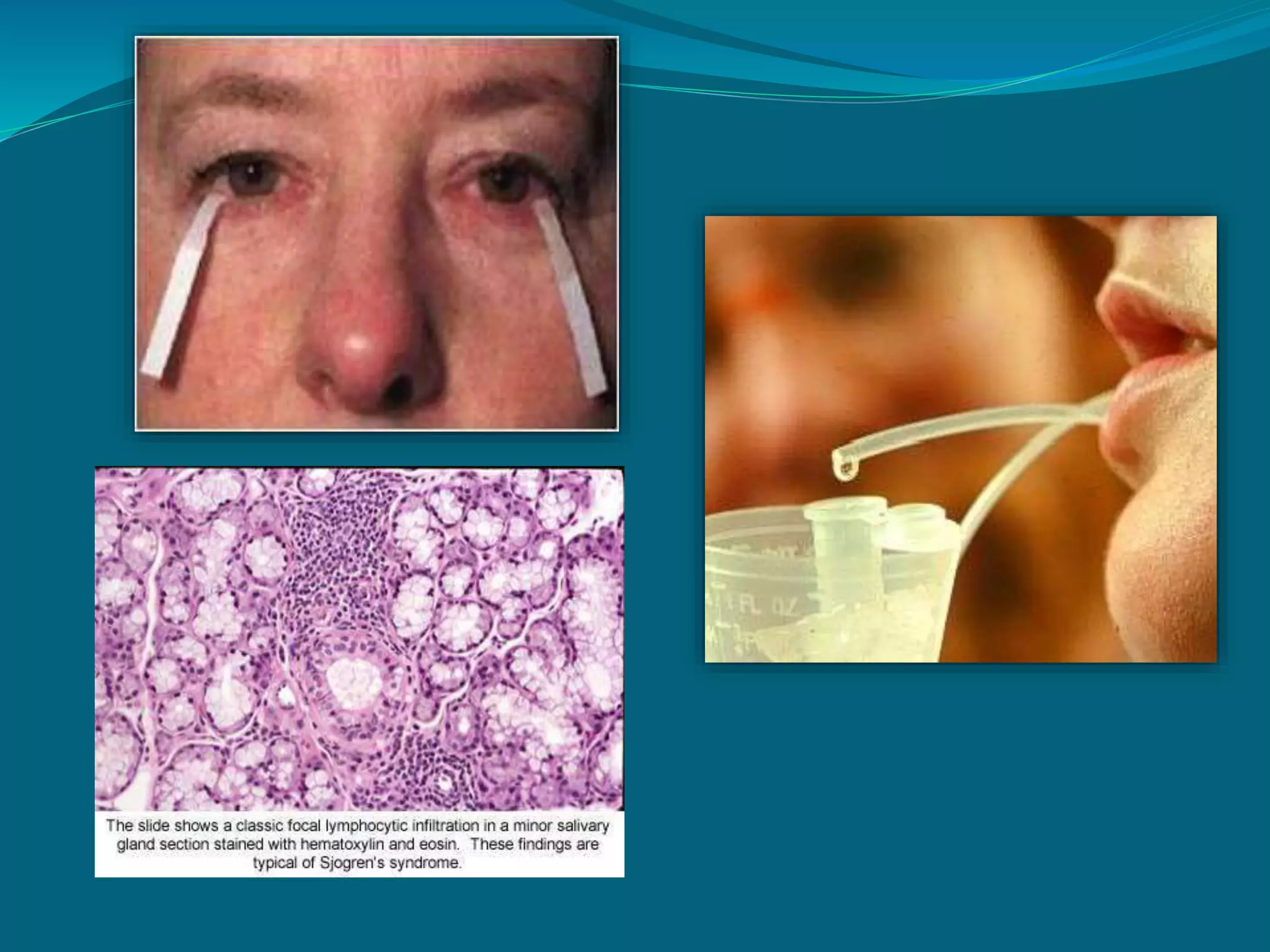 Sjogrens Syndrome - Clinical features, diagnosis and management | PPTX