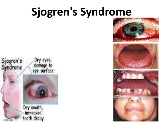 Sjogren's syndrome