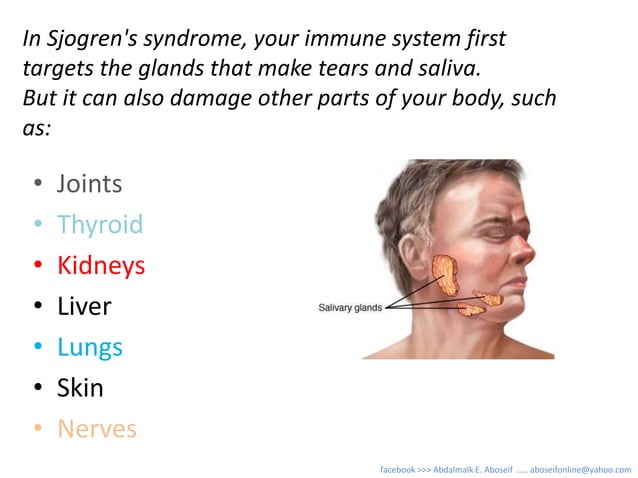 Sjogren's syndrome | PPTX | Eye and Vision Conditions | Diseases and ...