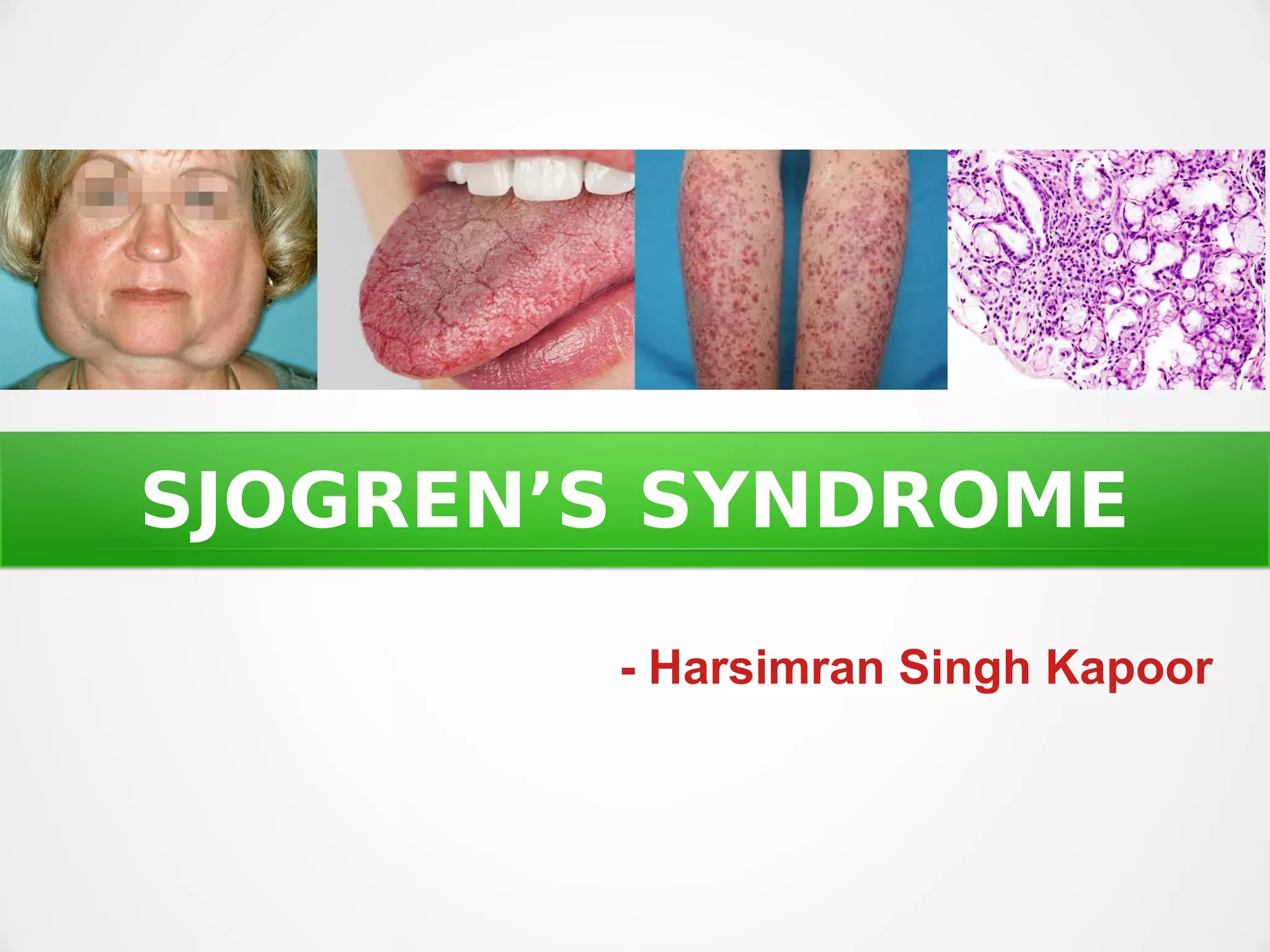 Sjogren's Syndrome | PDF