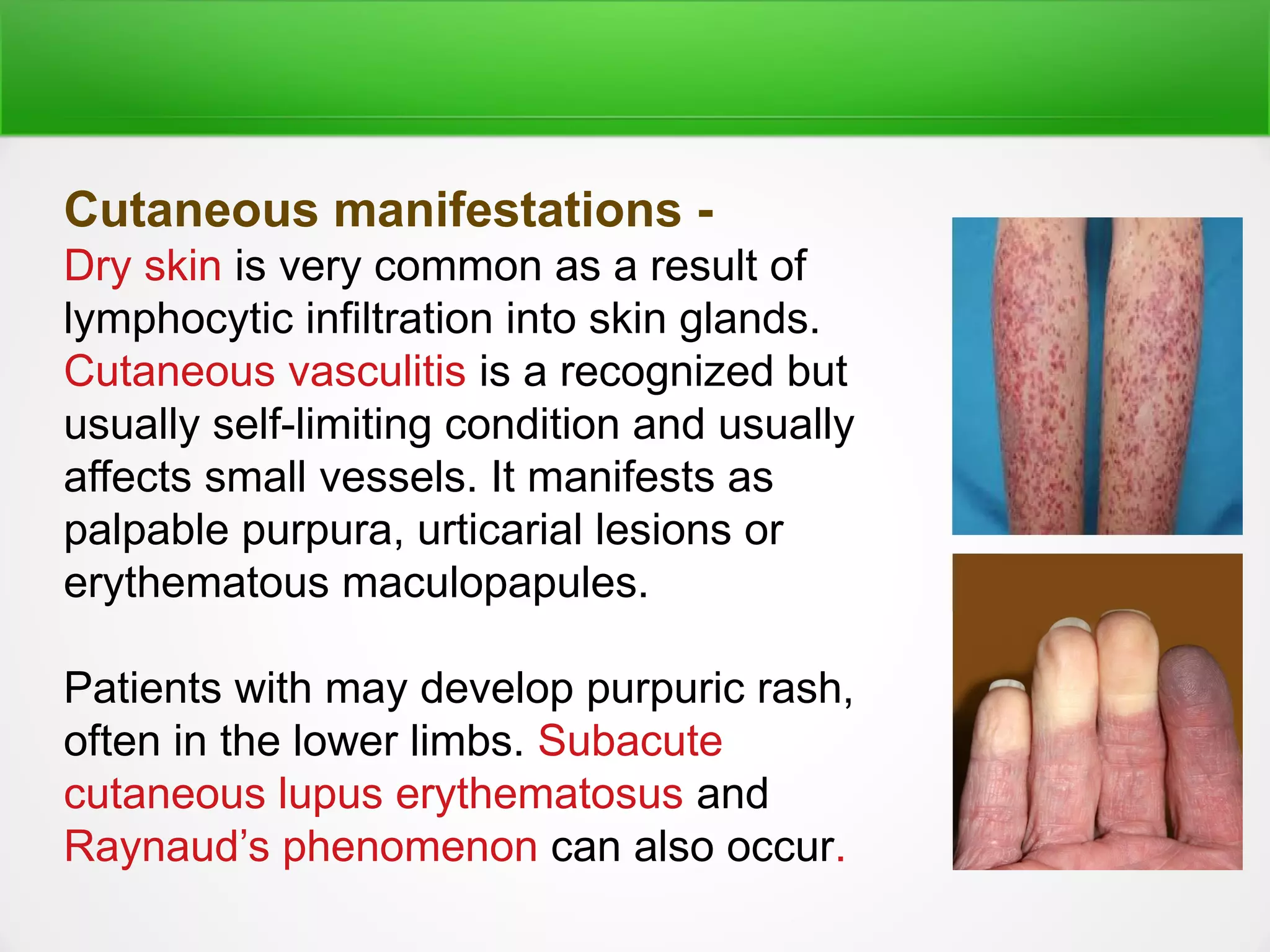 Sjogren's Syndrome | PDF
