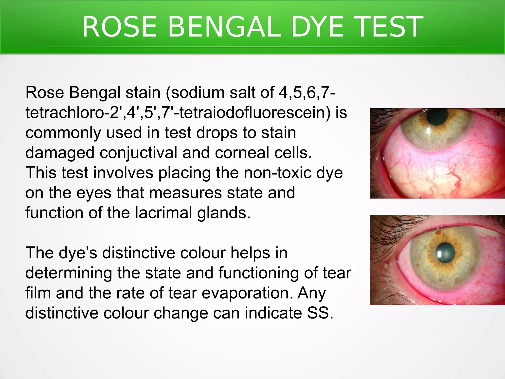 Sjogren's Syndrome | PDF
