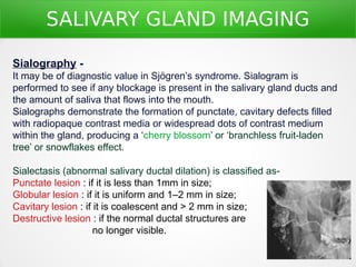 Sjogren's Syndrome | PDF