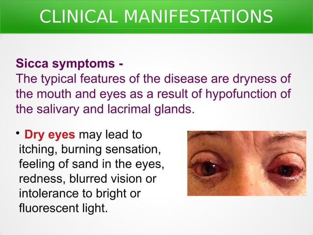 Sjogren's Syndrome | PDF | Ear, Nose and Throat Conditions | Diseases ...