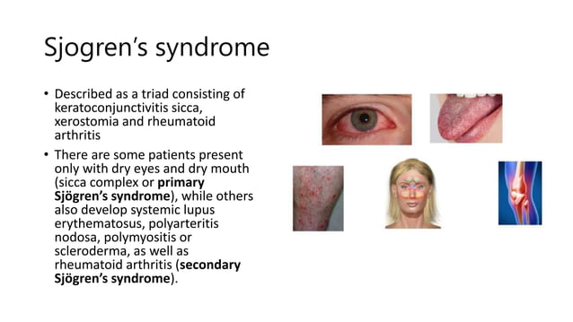 Sjogren’s syndrome.pptx
