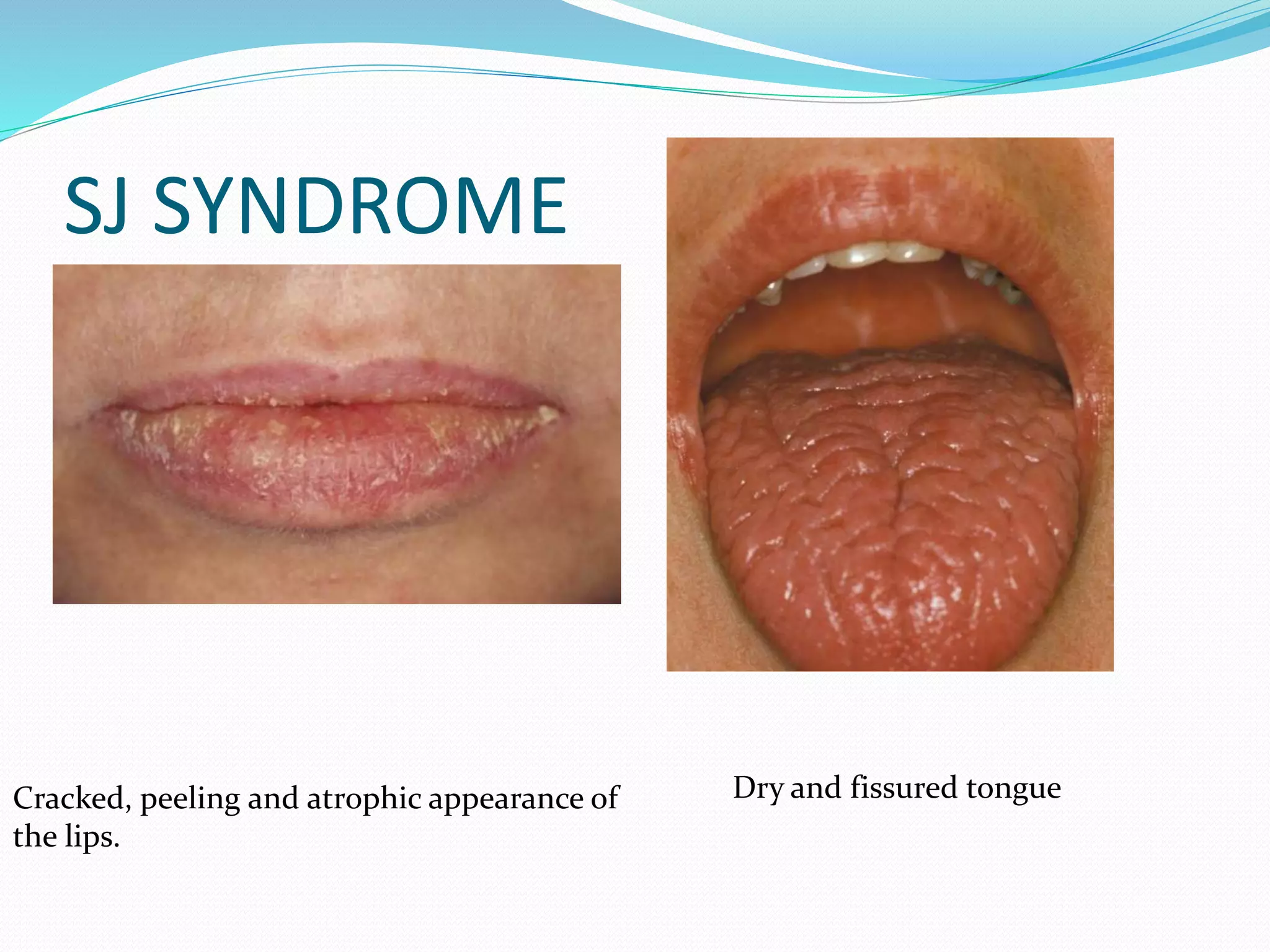 Sjogren syndrome | PPTX